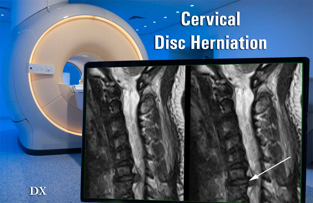 Cervical Disc Herniation : Top New York Cervical Spine Surgeon