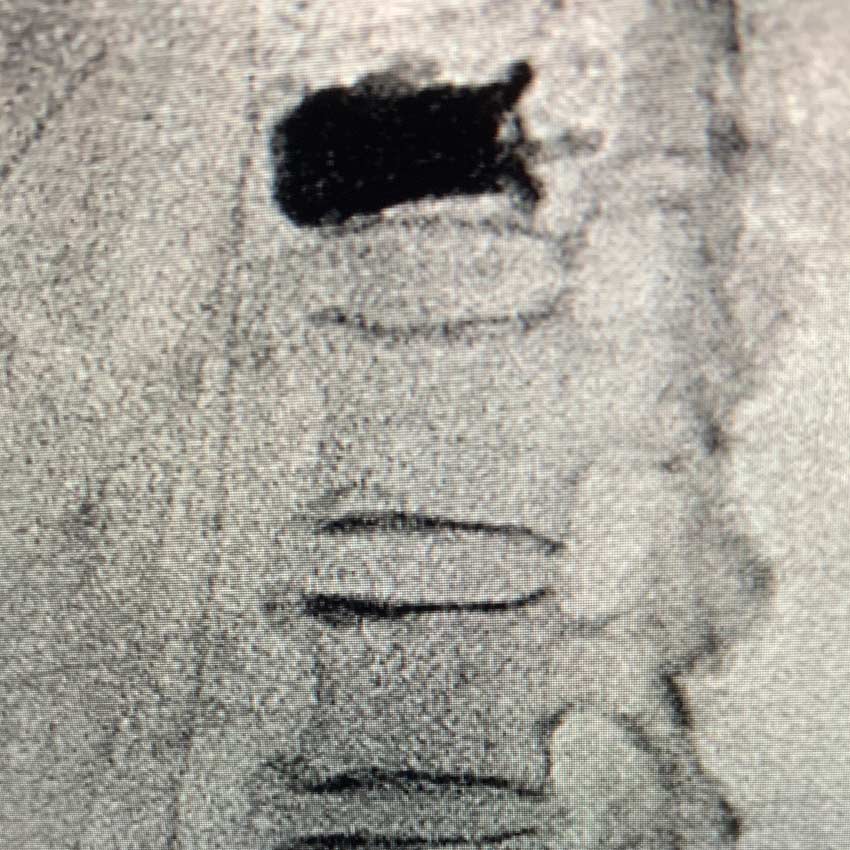 Kyphoplasty :: Jeffrey A. Goldstein, MD