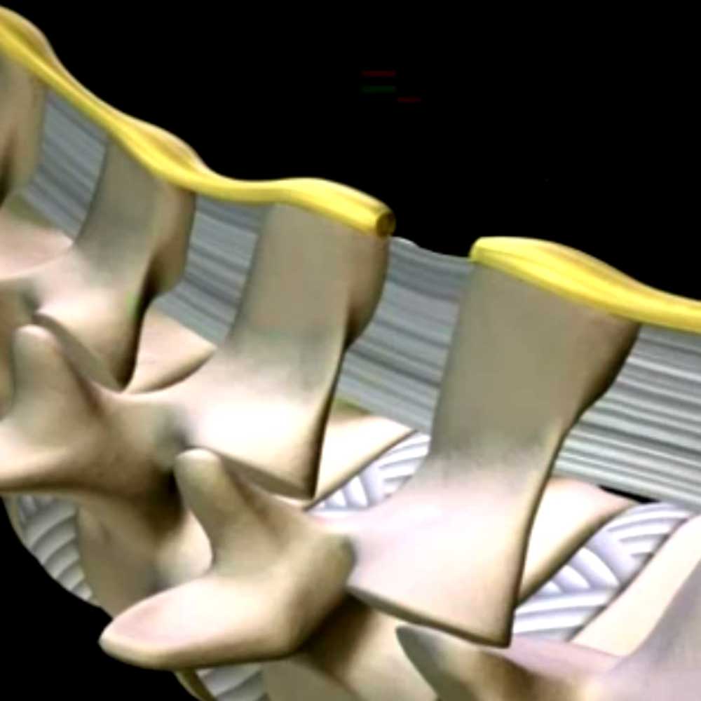 ILIF Procedure :: Jeffrey A. Goldstein, MD