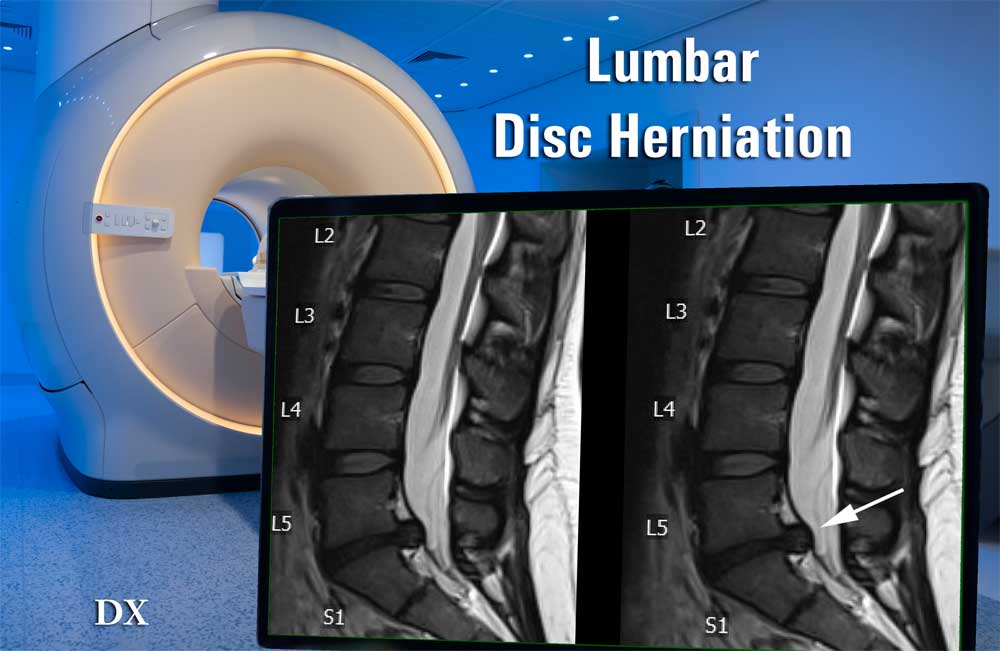 Lumbar Disc Herniation :: Jeffrey A. Goldstein, MD
