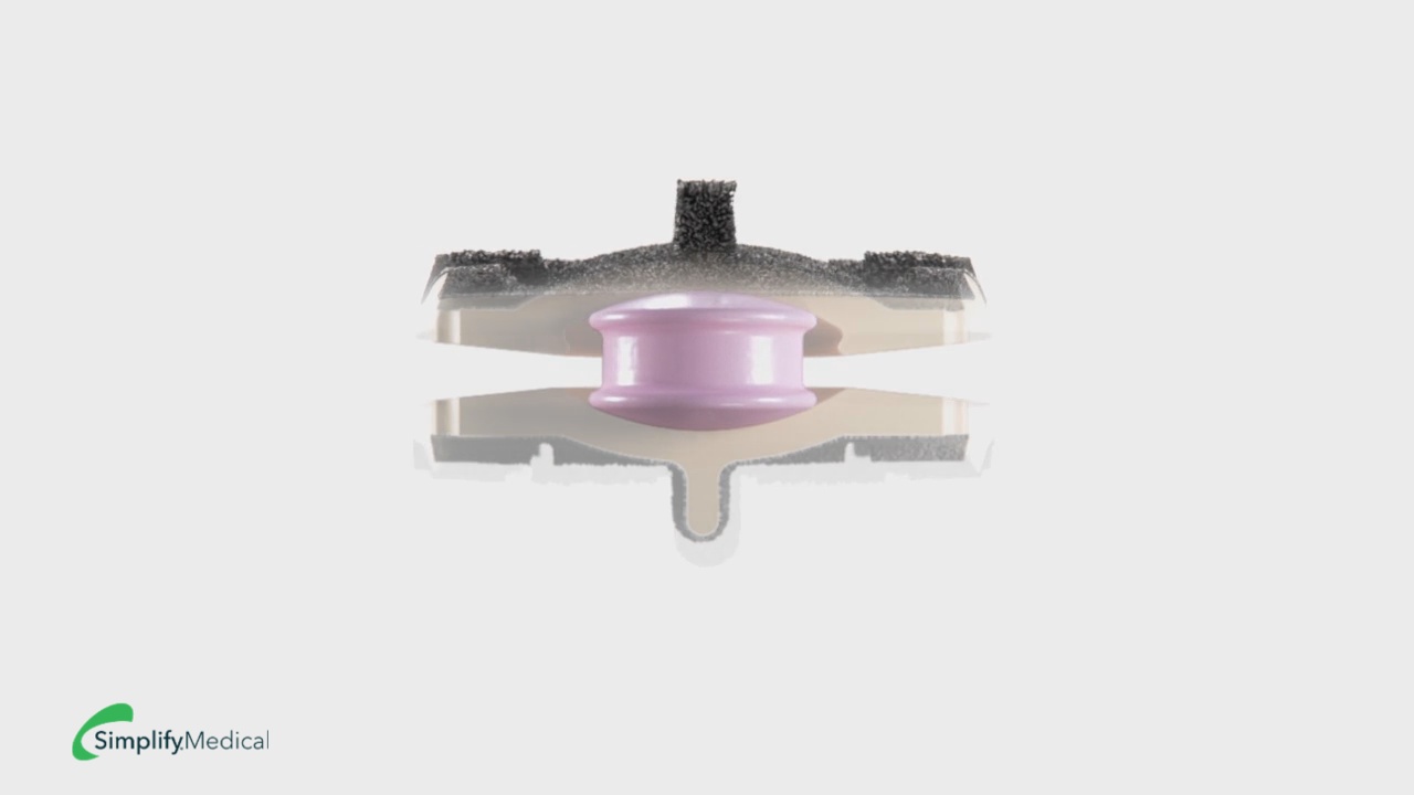 Simplify Cervical Disc Replacement : New York Cervical Spine Surgeon