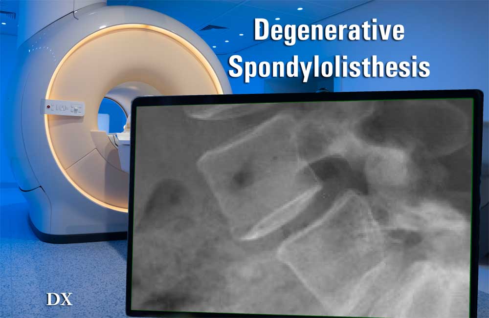 Degenerative Spondylolisthesis :: Jeffrey A. Goldstein, MD